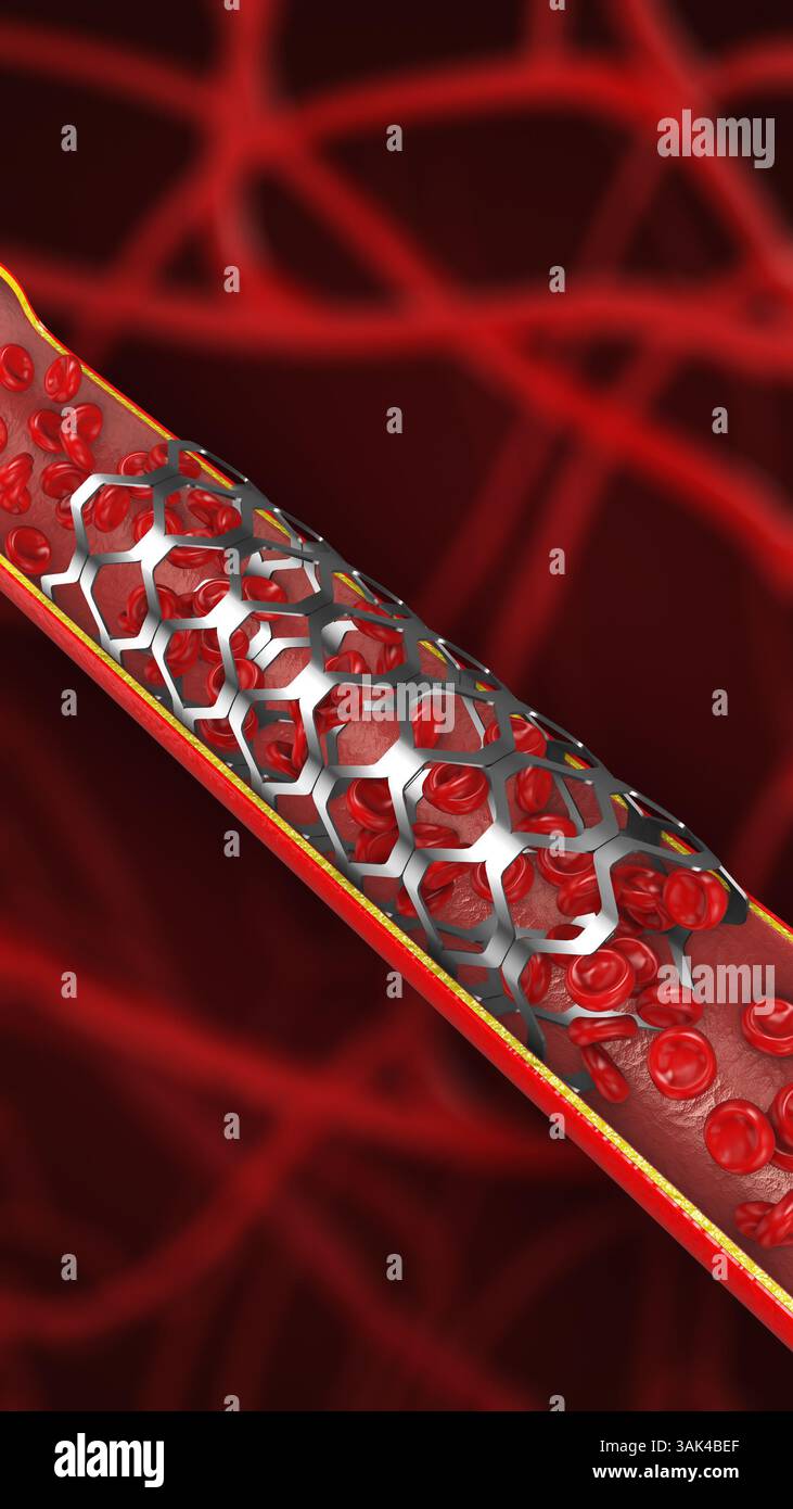 Blocked Artery and Blood Flow Circulation Stock Photo - Alamy
