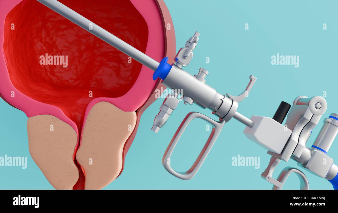 A 3d rendering of resectoscope and benign prostatic hyperplasia or BPH ...