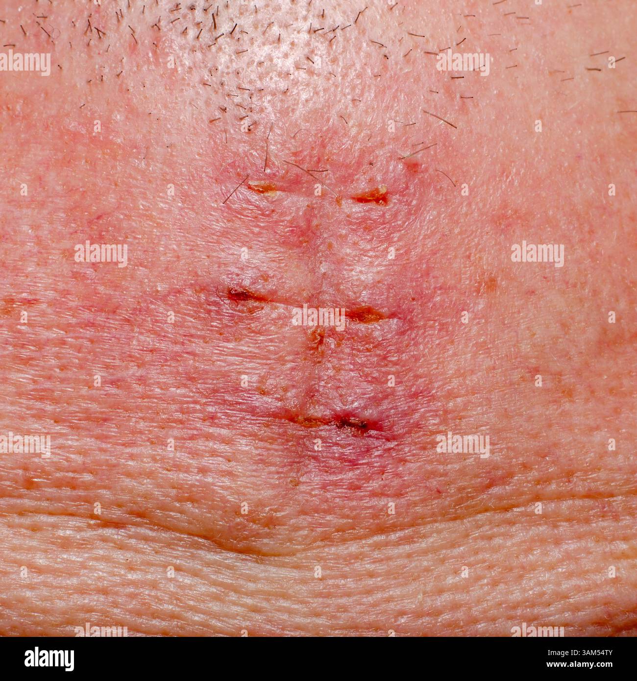 Healing surgical stitches on irritated skin Stock Photo - Alamy