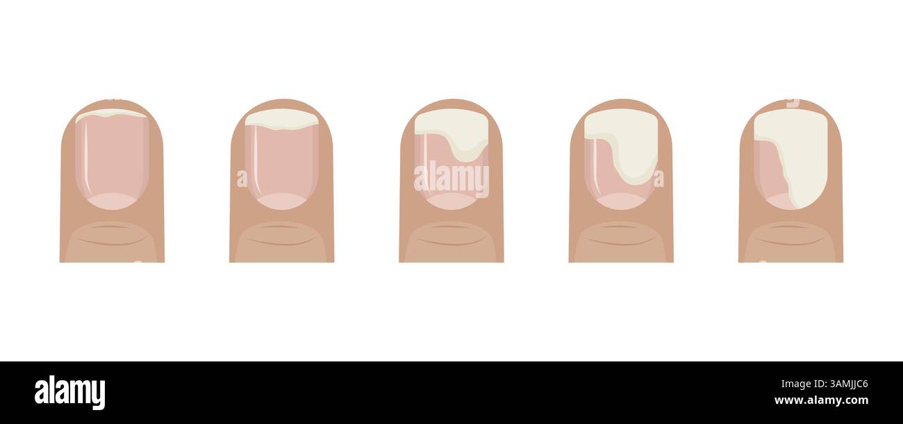 Onycholysis stages showing nail separating from nail bed Stock Vector ...