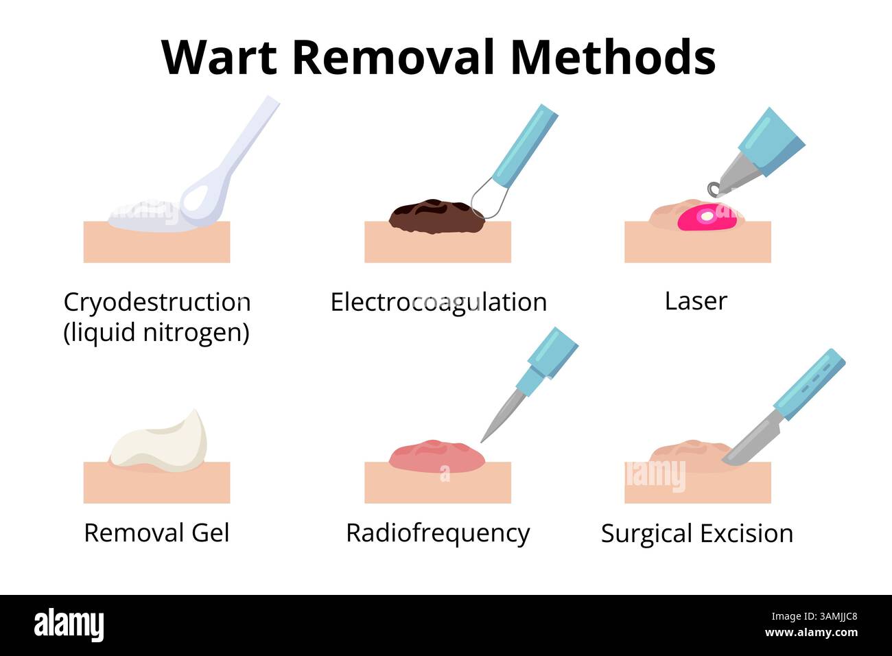 Different wart removal methods illustrations Stock Vector Image & Art ...