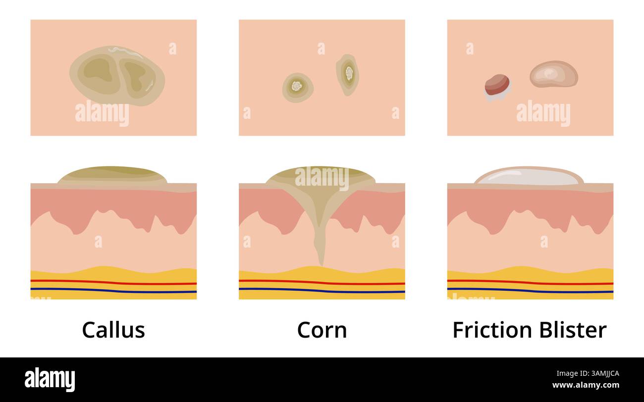 Callus, Corn and Friction Blister on Human Skin Cross Section Stock ...