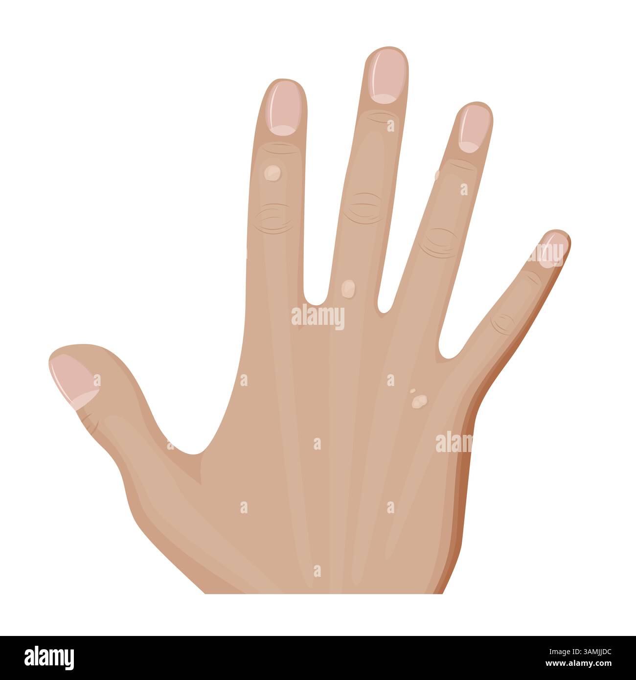 Verruca vulgaris Stock Vector Images - Alamy