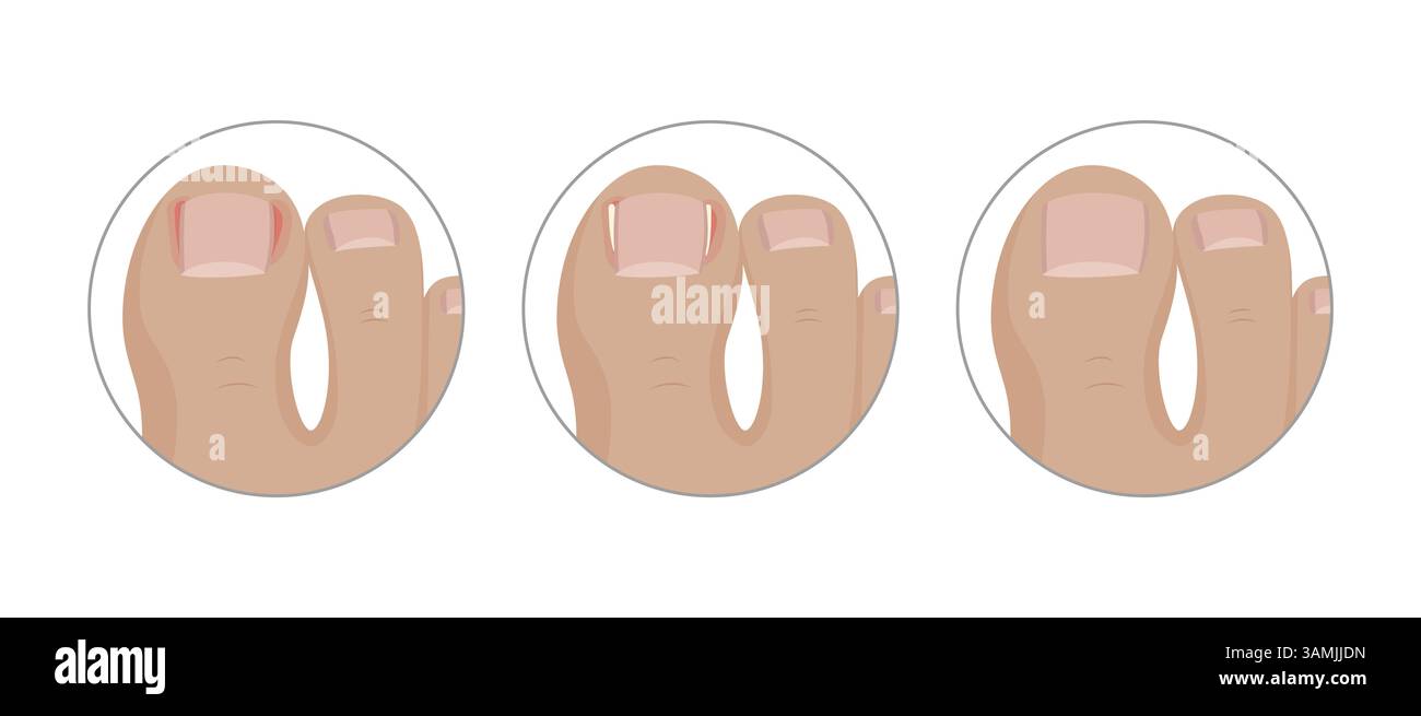 Ingrown toenail surgery using a tamponade, three steps of healing ...