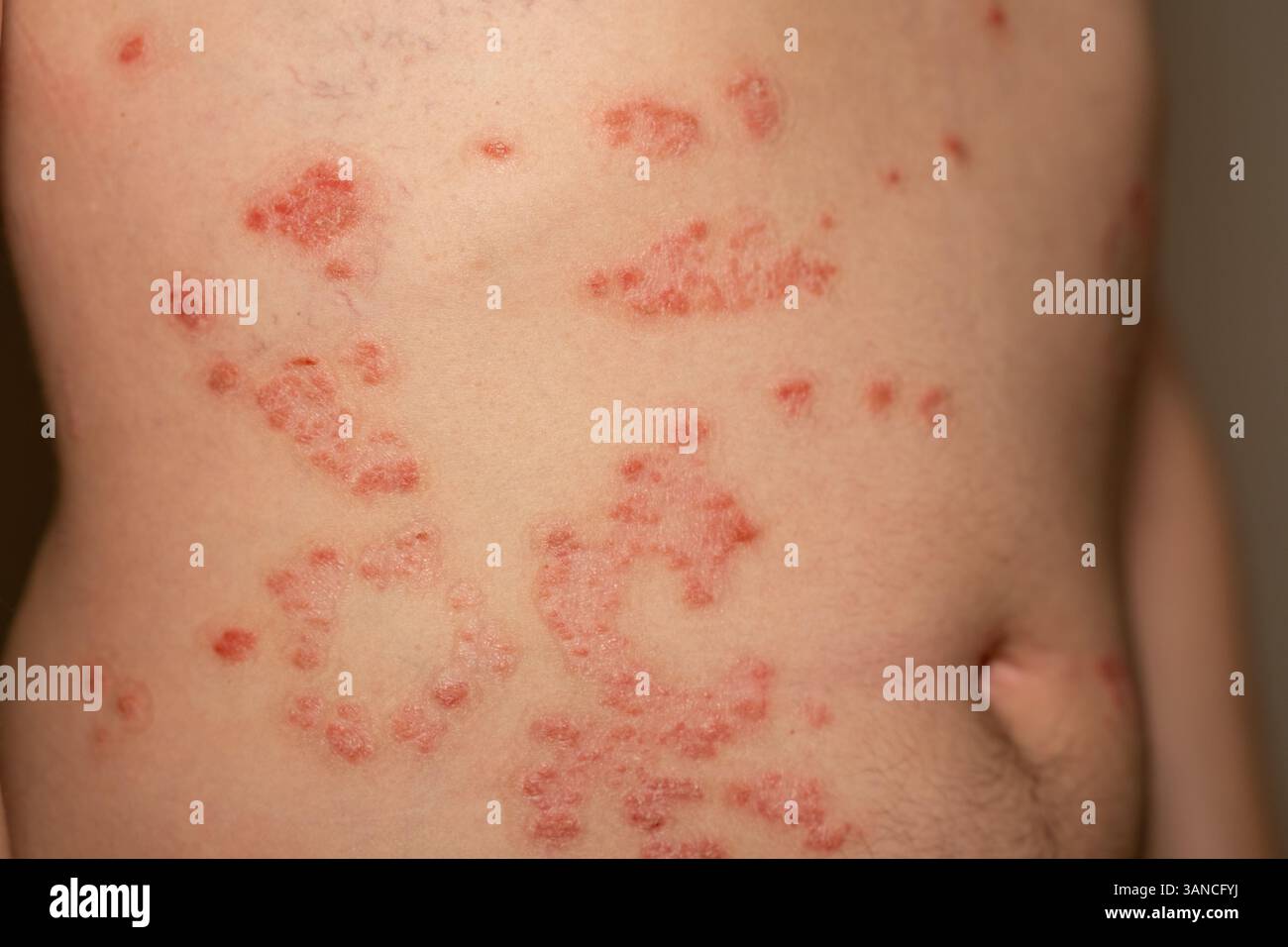 Understanding psoriasis through the observation of red, itchy, scaly ...