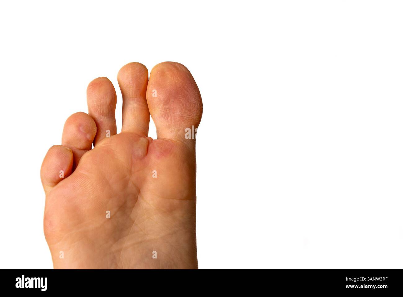 Human foot affected by blisters due to medical condition known as ...