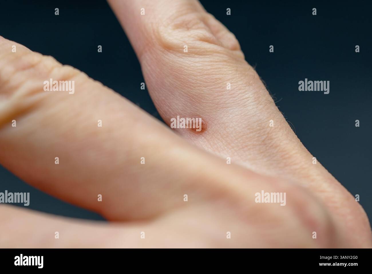Papilloma on the finger, common wart Verruca vulgaris a flat wart on a ...