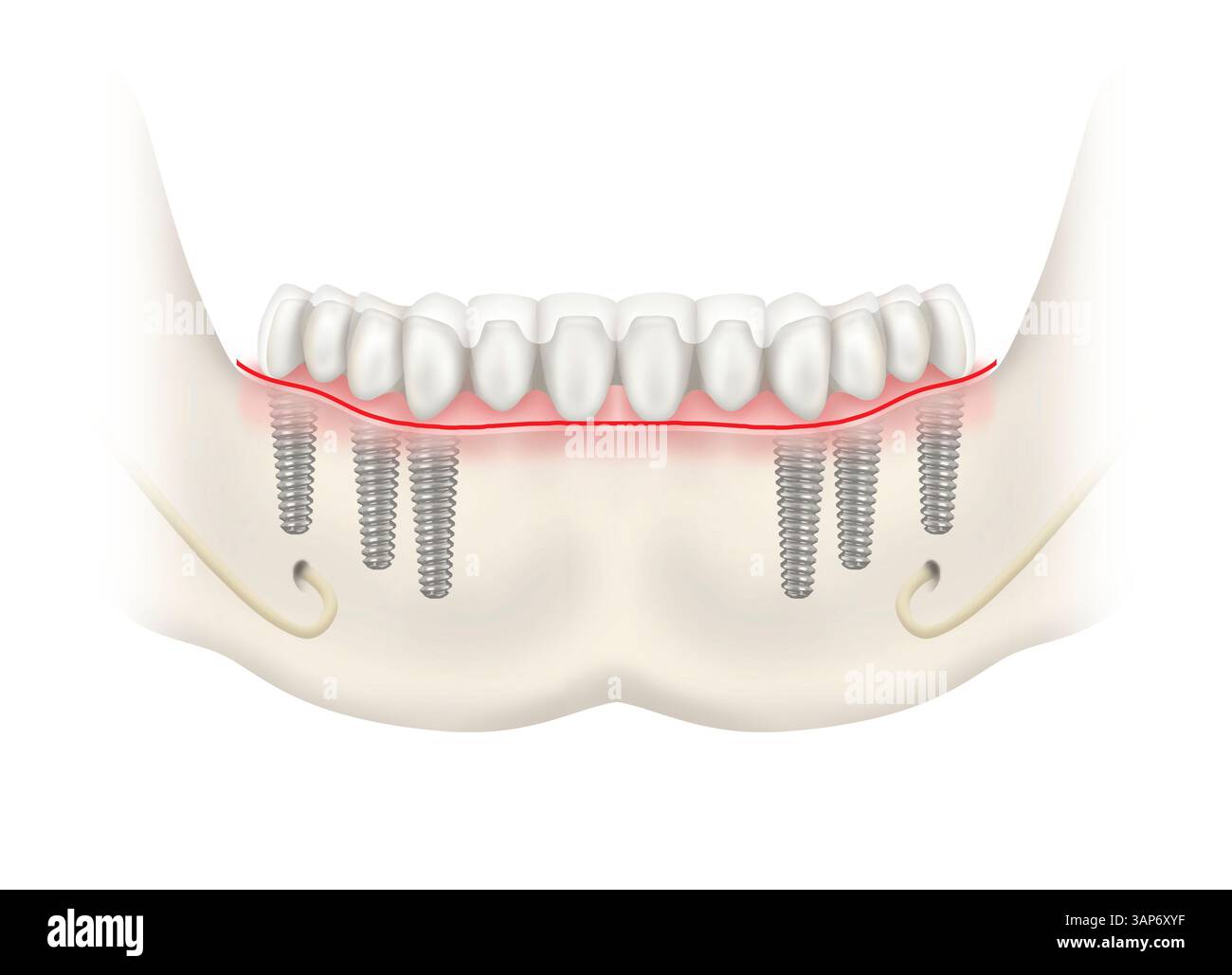 Illustration of a mandible (lower jaw) a prosthesis secured to a ...