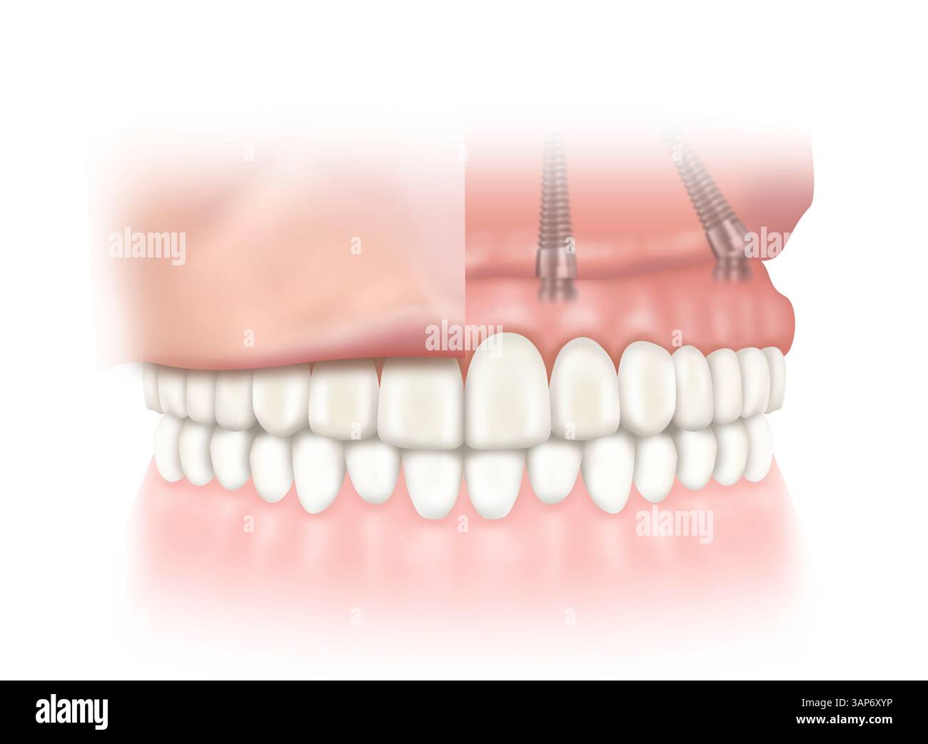 Illustration of a normal lip drape with a maxillary (upper jaw ...