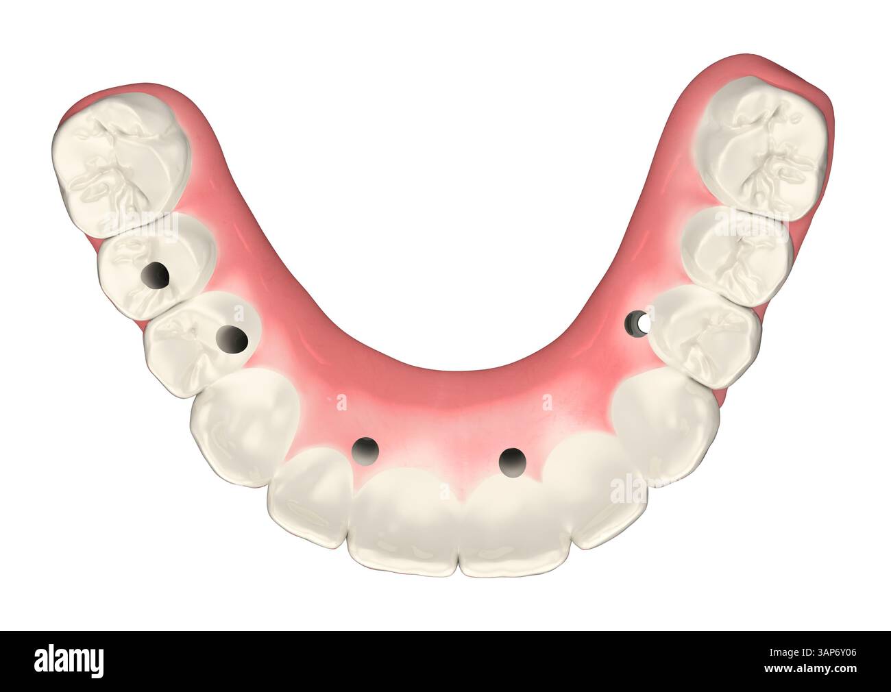 Dental maxillary (upper jaw) prosthesis with teeth and gingiva ...