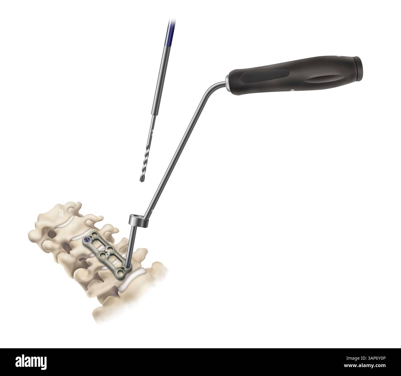 Illustration of anterior cervical plate surgery, showing the angle to ...
