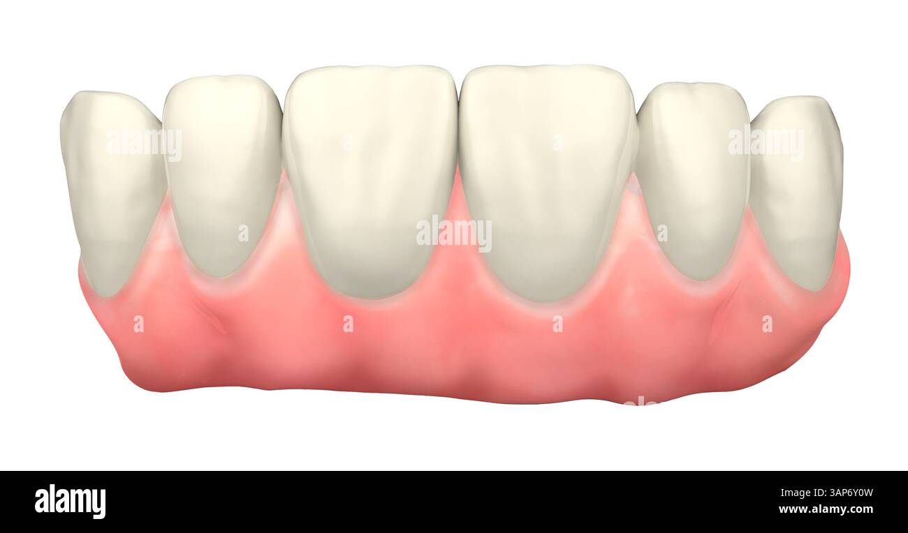 Six-tooth dental maxillary (upper jaw) prosthesis with teeth and ...