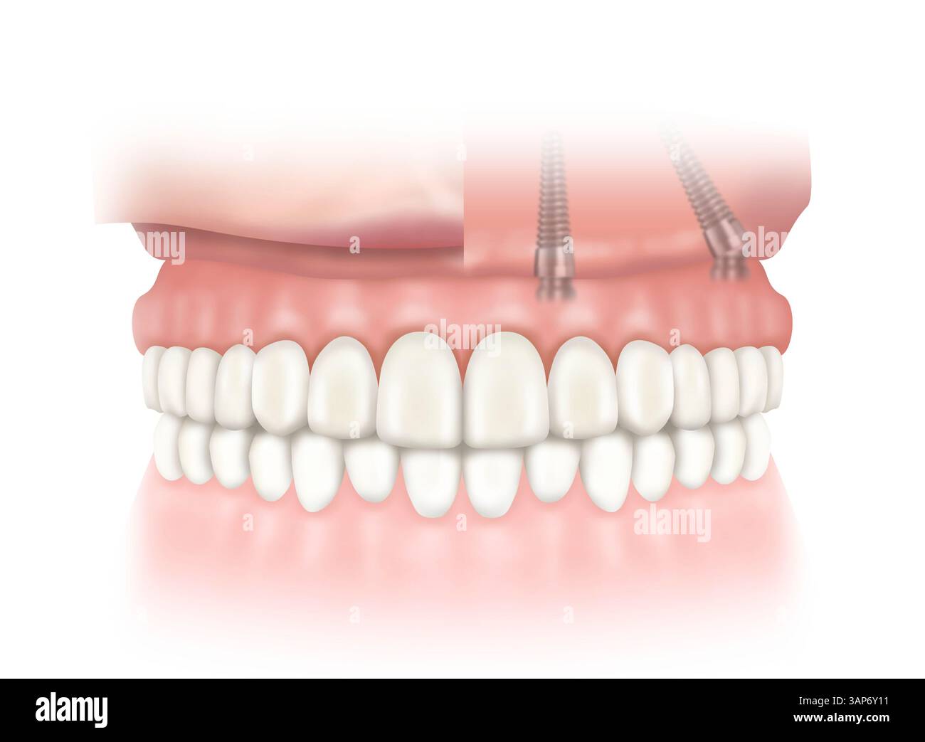 Illustration of an elevated lip drape with a maxillary (upper jaw ...