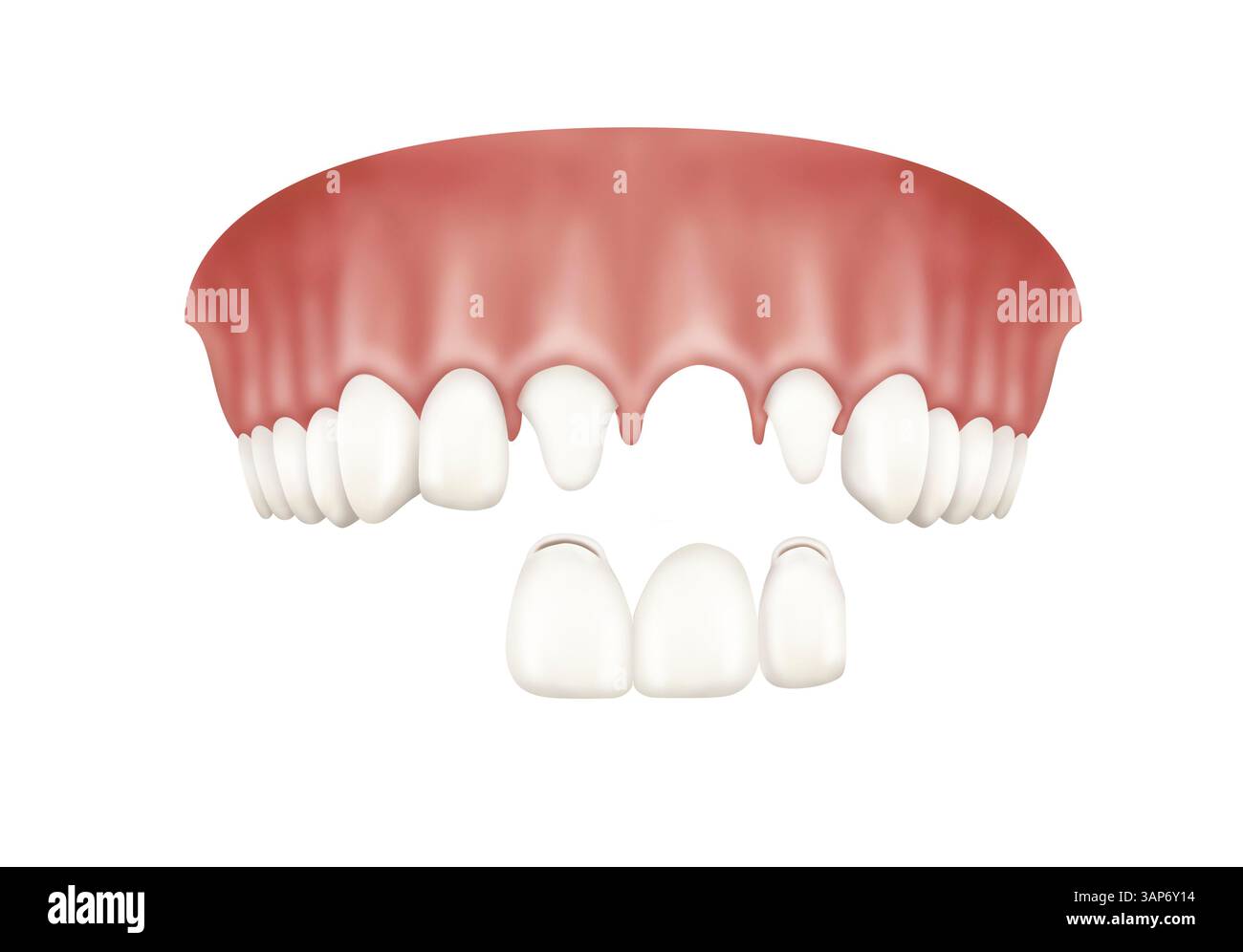 Illustration of a three-tooth bridge in the central maxilla (upper jaw ...