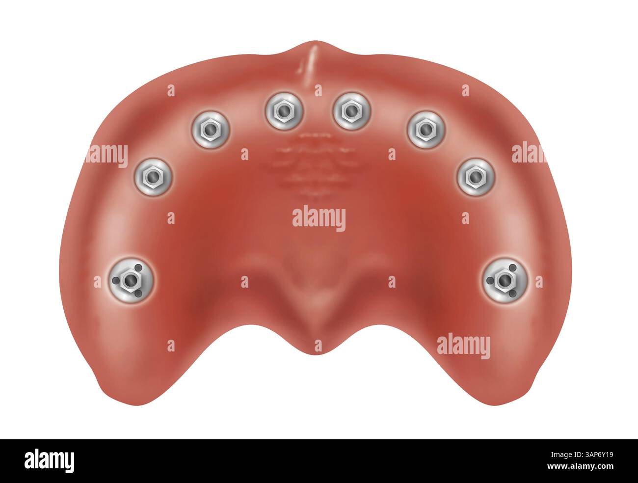 Illustration showing the dental implant placement for the AP (anterior ...
