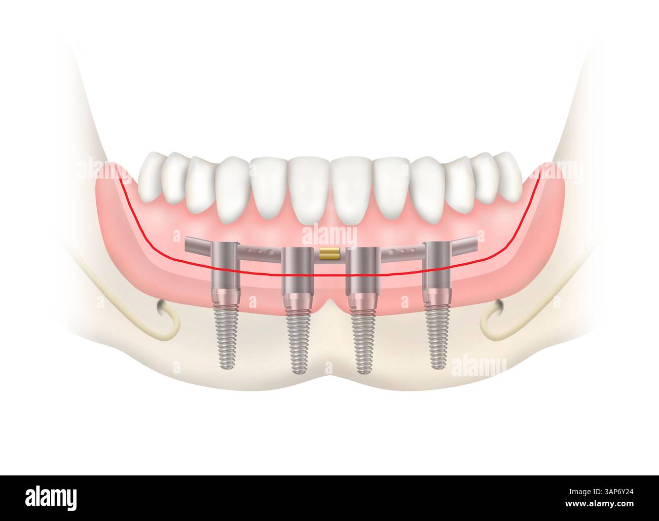 Illustration of a mandible (lower jaw) with a bar-supported prosthesis ...