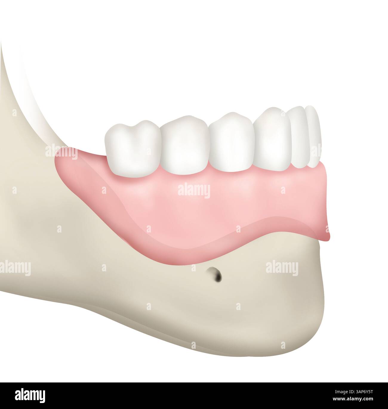 Illustration of a resorbed mandible (lower jaw) with an angled ...