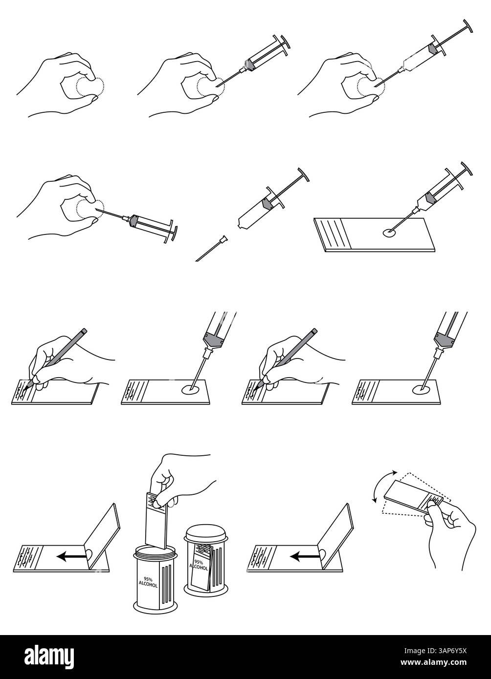 Illustration of the steps involved in fine needle aspiration (FNA). FNA ...