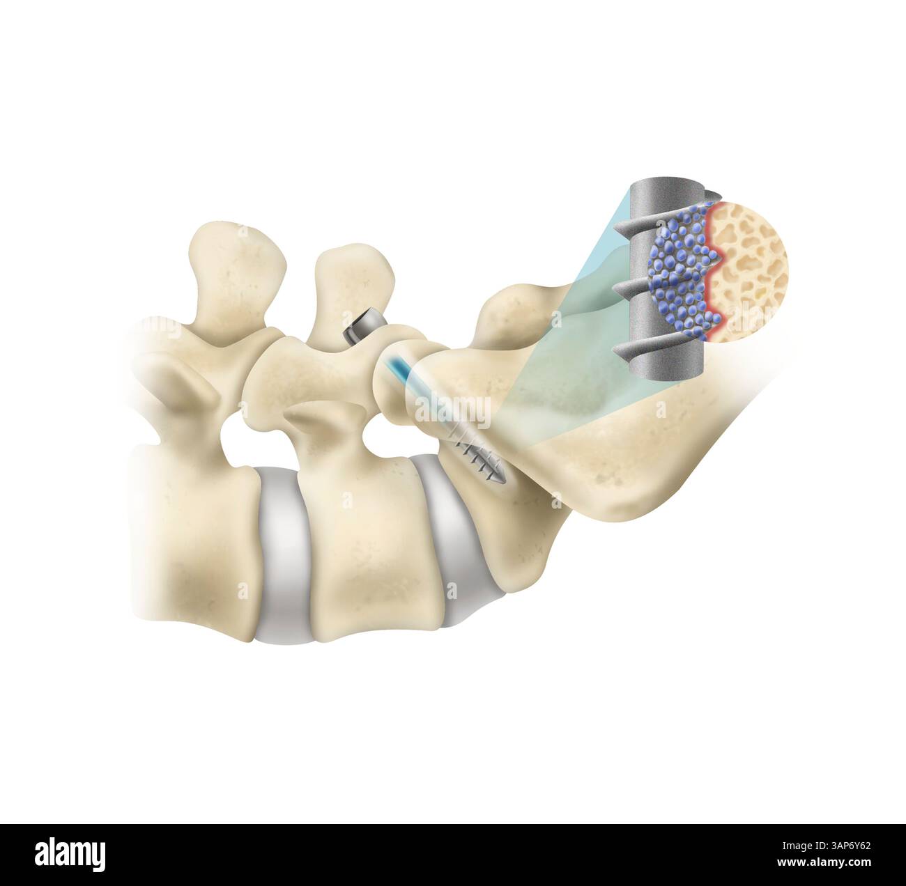 Illustration of a lateral view of the sacrum and pelvis showing an ...