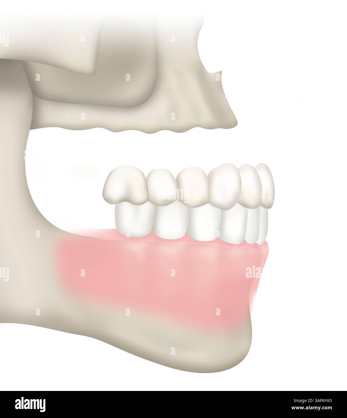 Illustration showing a resorbed maxilla (upper jaw) that is recessed ...