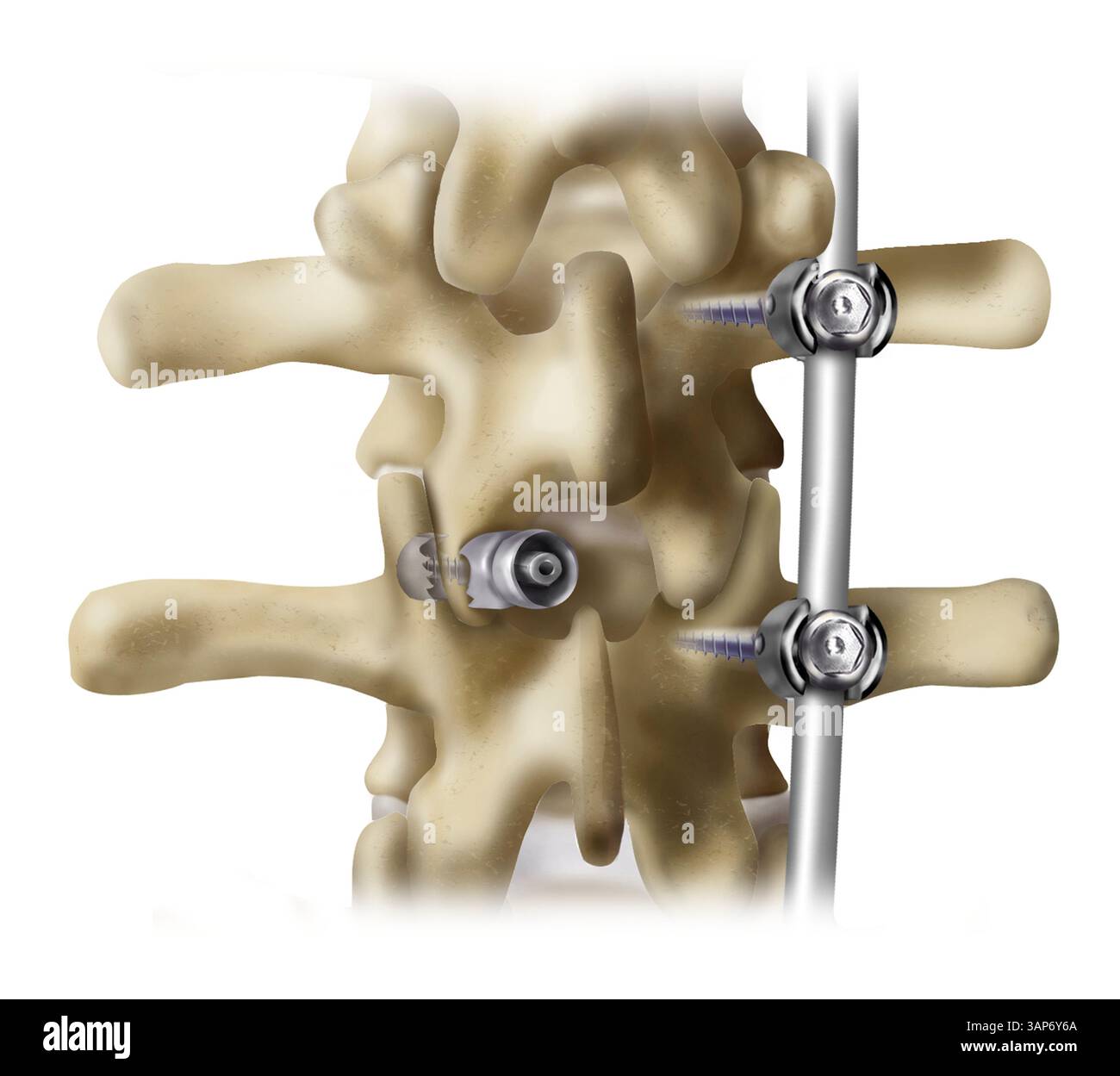 Illustration of the posterior lumbar (lower back) vertebrae showing the ...