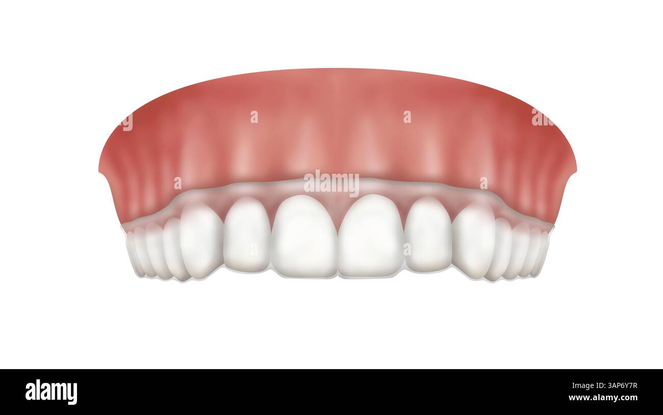 Illustration of a maxillary (upper jaw) arch with a clear retainer ...