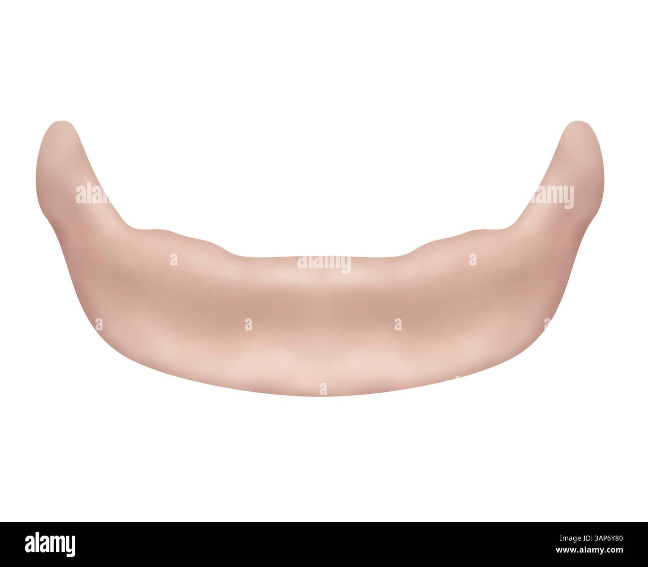 Illustration of a resorbed mandibular edentulous jaw, showing the ...