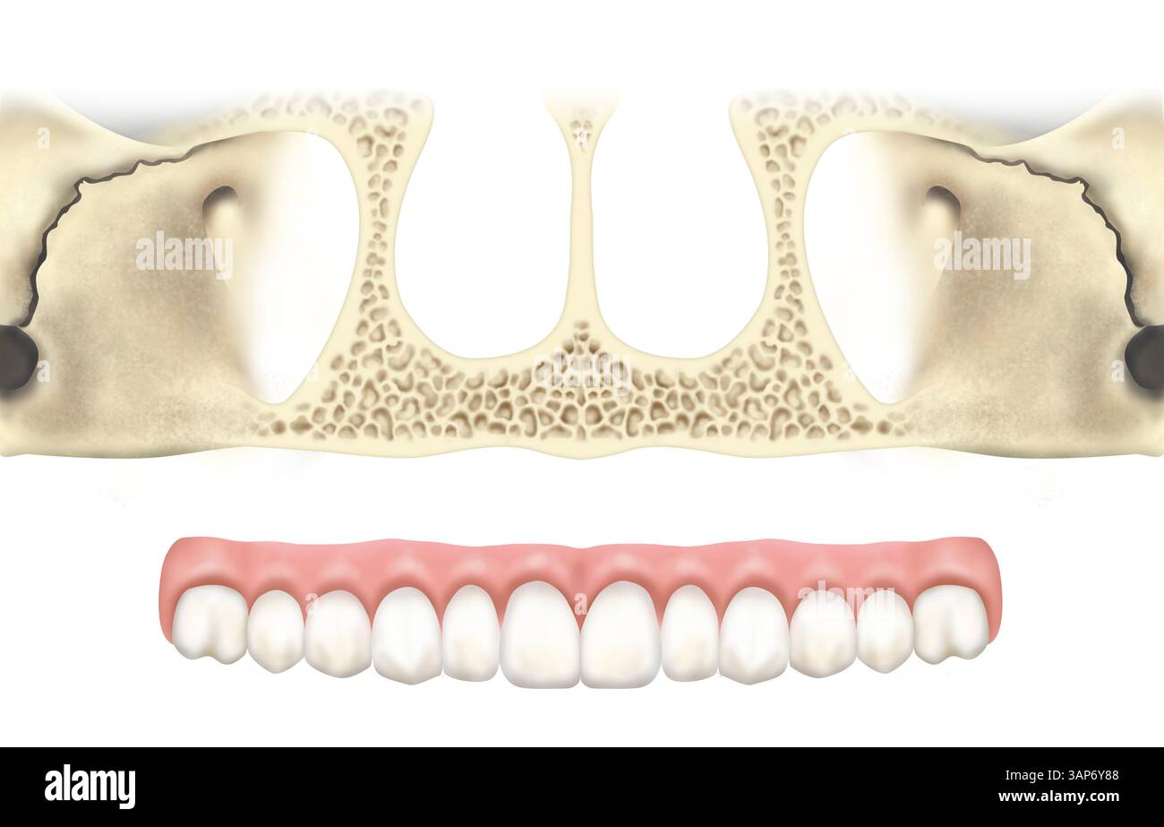 Illustration of a maxillary (upper jaw) arch 12-teeth prosthesis with a ...