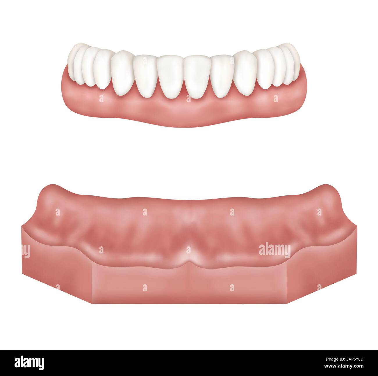 Illustration of a mandibular (lower jaw) arch prothesis and edentulous ...