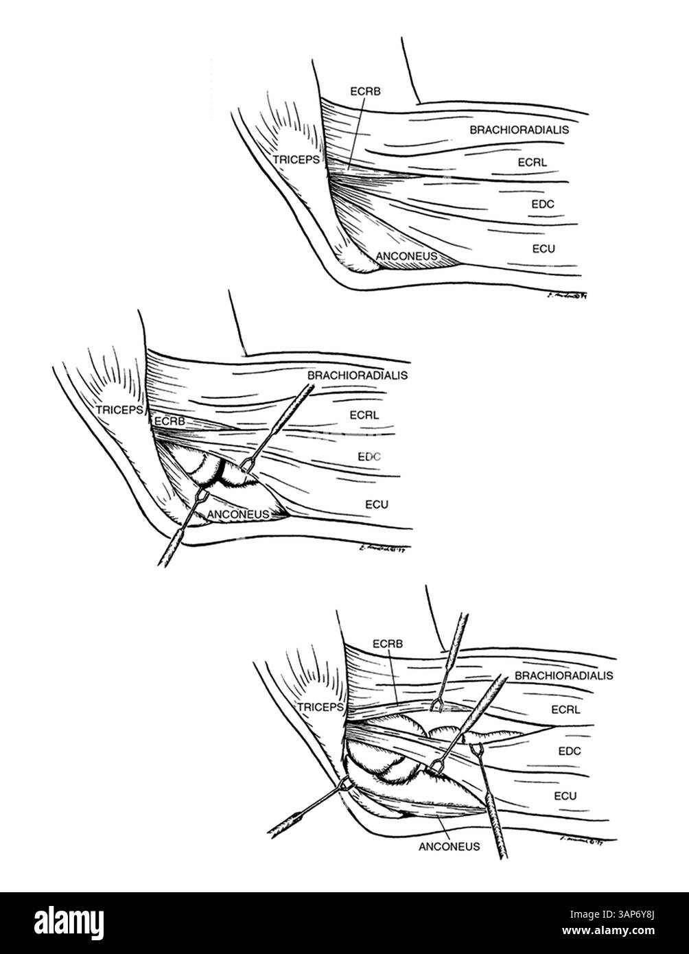 Illustration of three surgical approaches to the elbow, with the ...