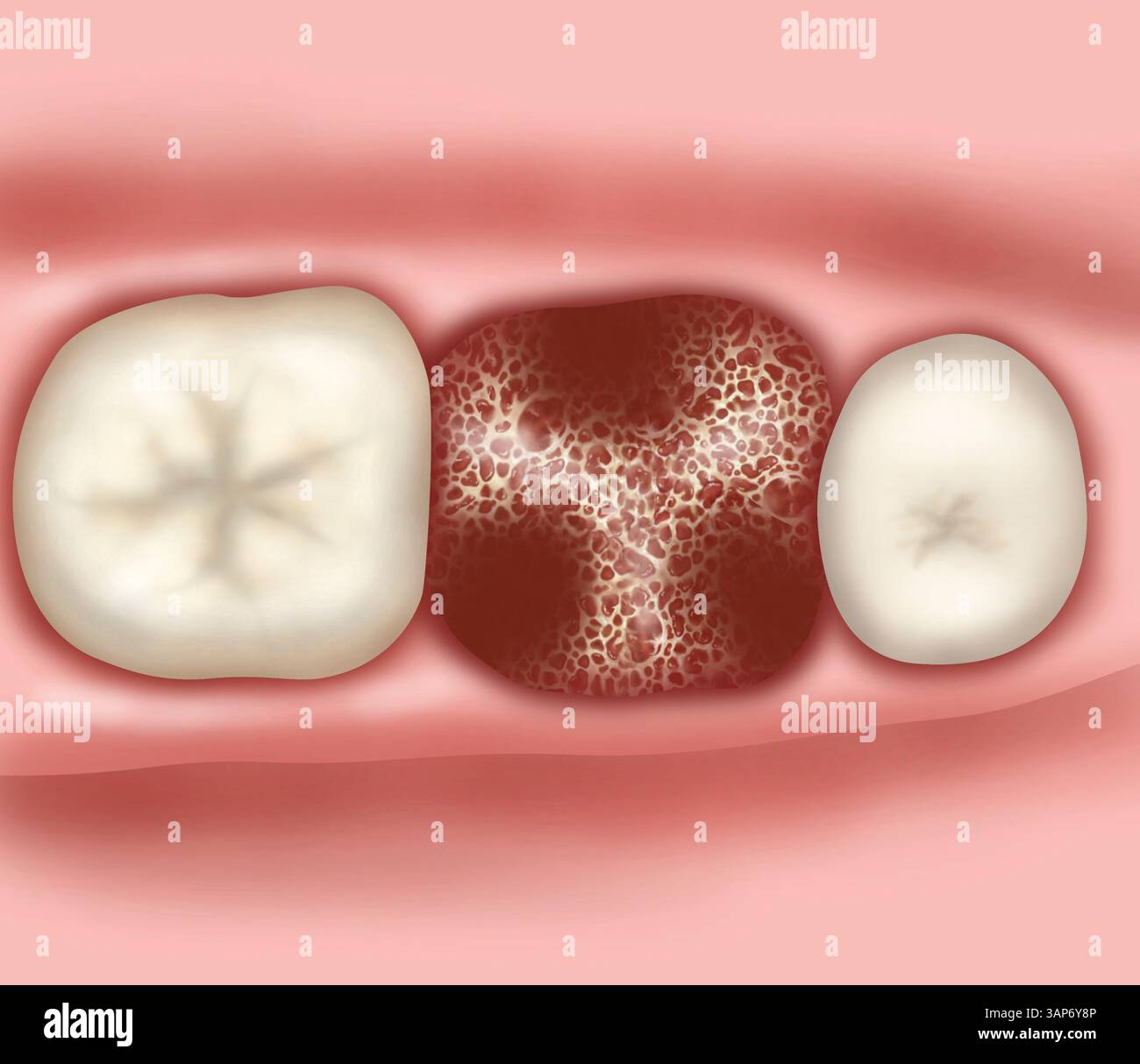 Illustration of a molar socket with the jaw bone exposed. There is ...
