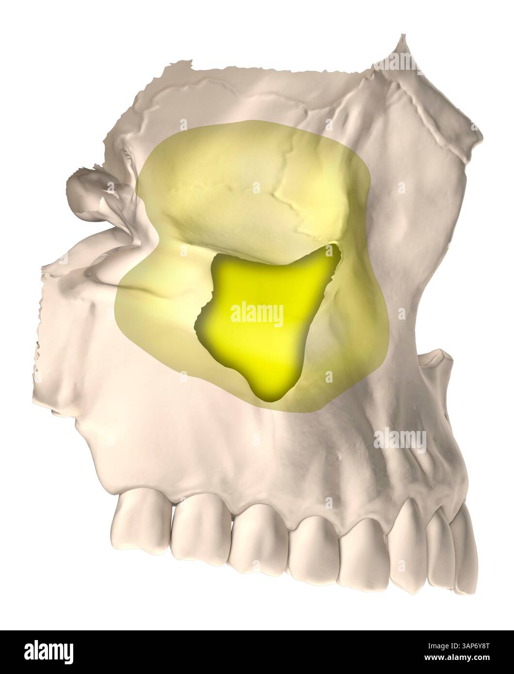 Illustration of the maxilla (upper jaw) with cheek (zygoma) bones and ...