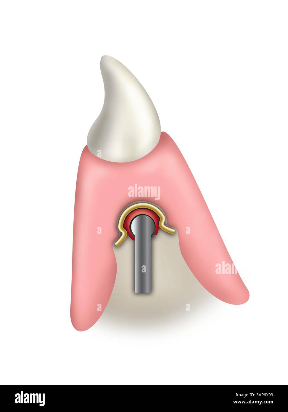 Illustration of a mandibular (lower jaw) tooth with a bar-supported ...