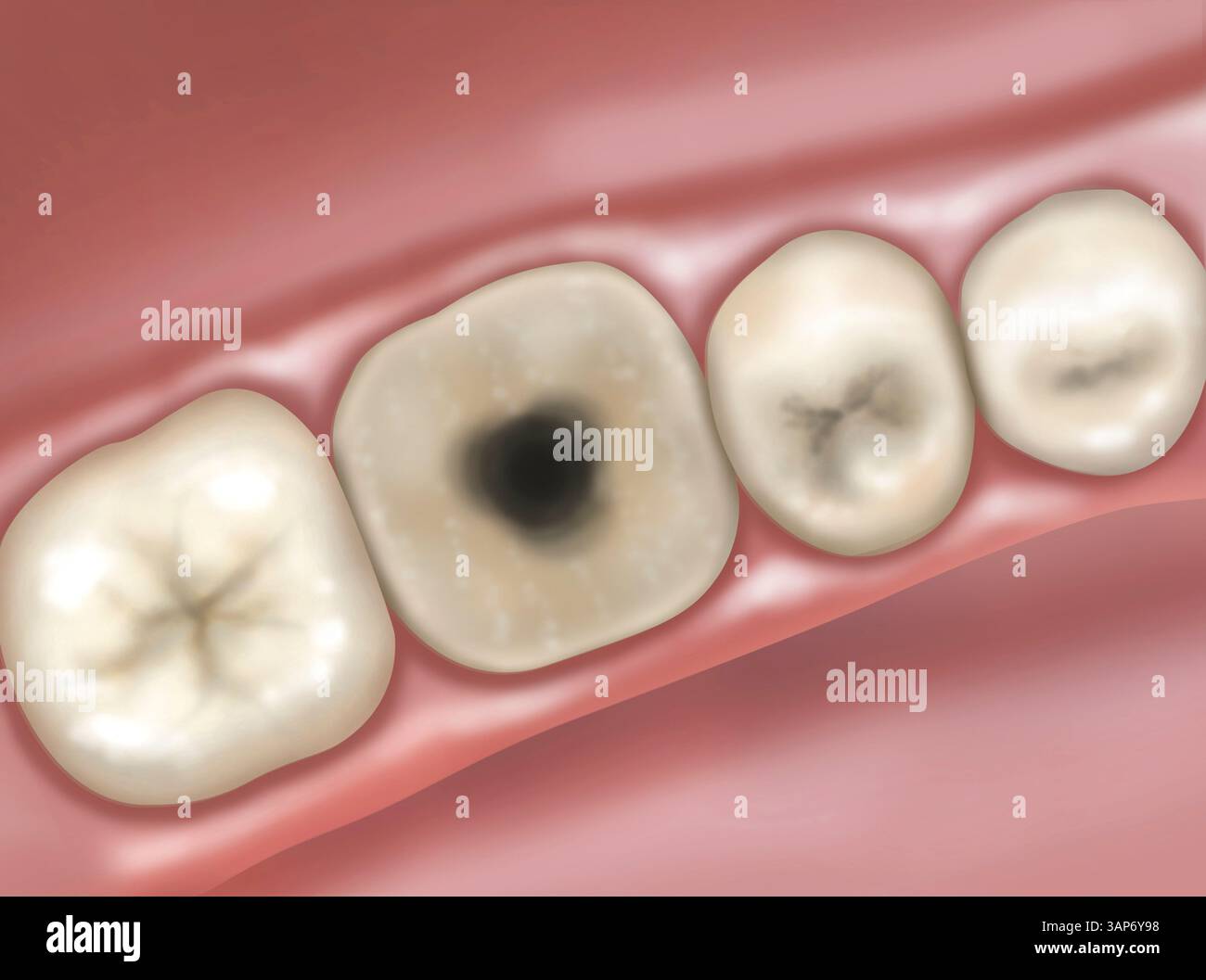 Illustration of a decrowned molar with a clear drill hole present at ...