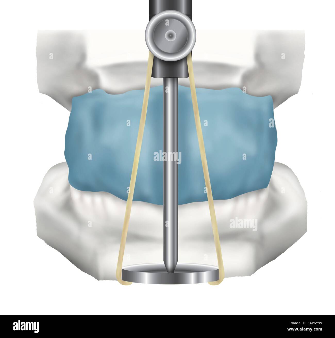 Illustration of a dental articulator with blue putty matrix, showing ...