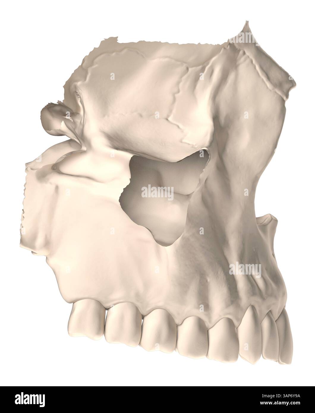 Illustration of the maxilla (upper jaw) with cheek (zygoma) bones and ...
