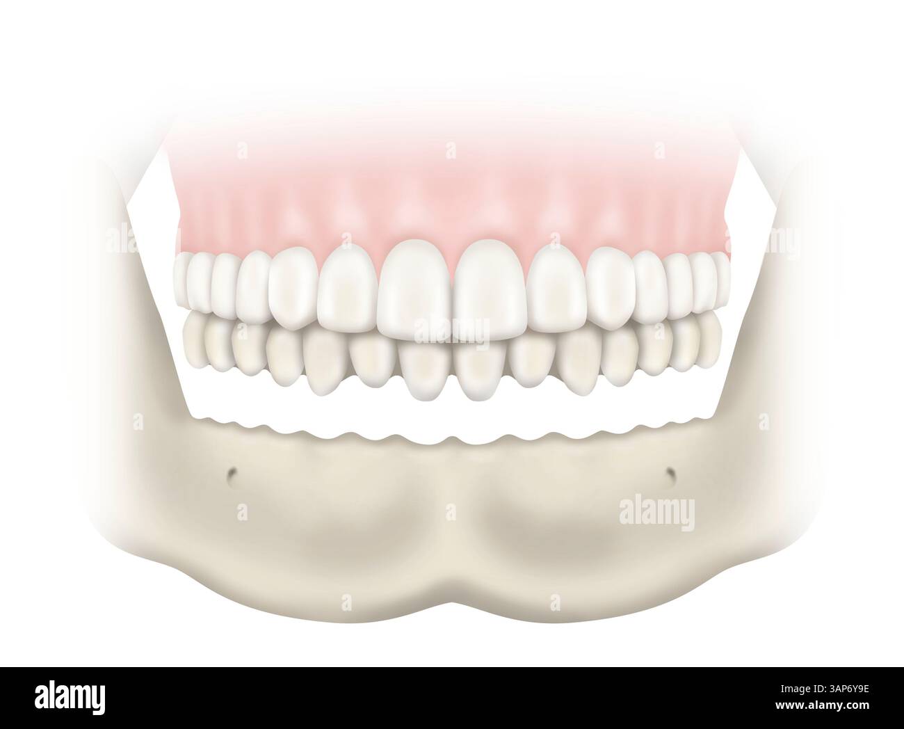 Anterior resorbed mandible (lower jaw) with composite defect ...