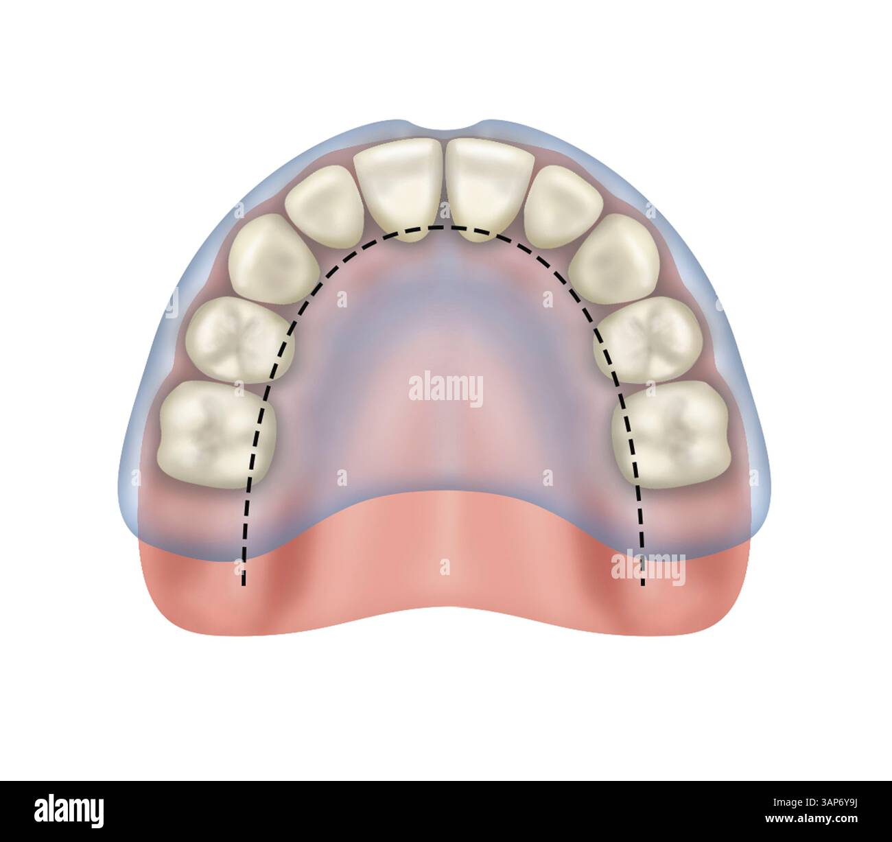 Illustration of a resorbed edentulous maxillary (upper jaw) arch with a ...