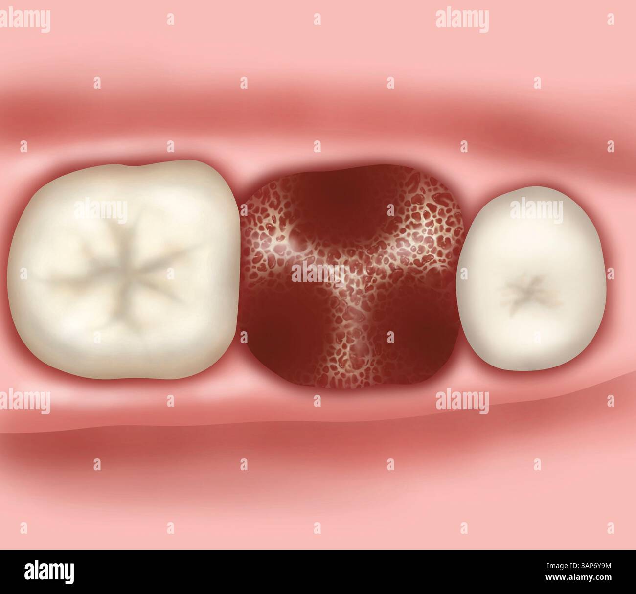 Illustration of a molar socket with a resorbed jaw bone exposed. There ...