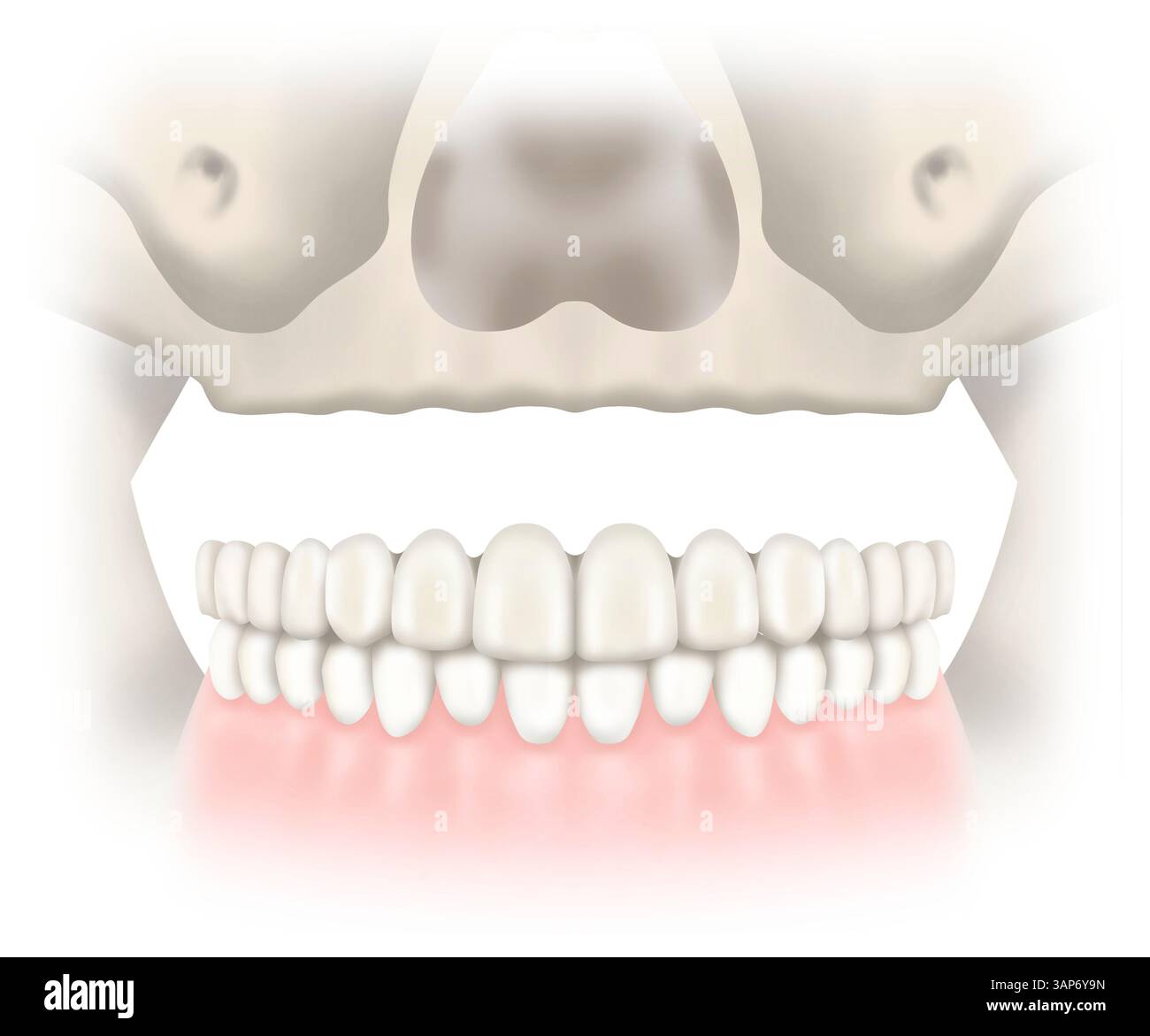 Severely resorbed maxilla (upper jaw) with composite defect ...