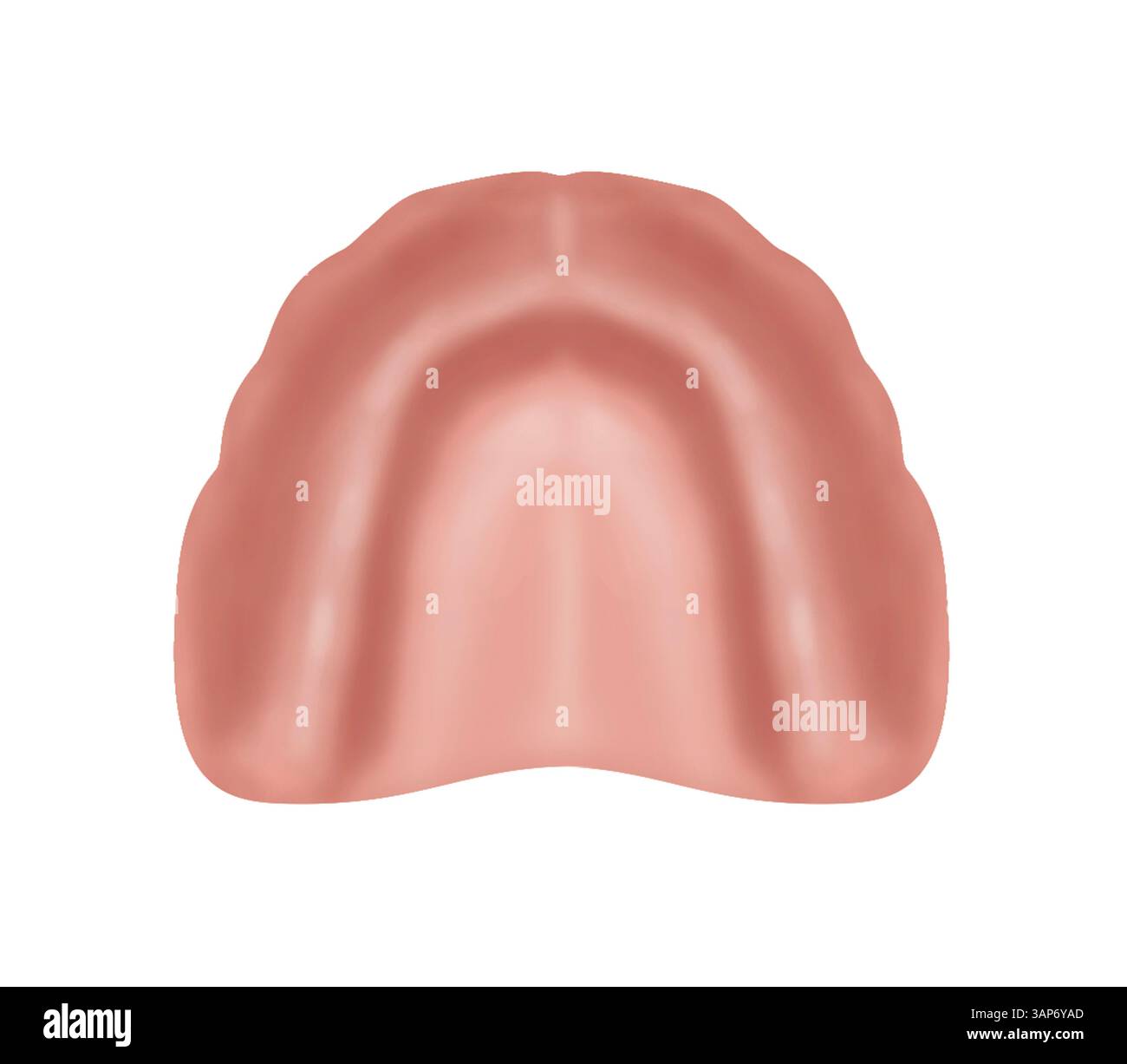 Illustration of a mildly resorbed edentulous maxillary (upper jaw) arch ...