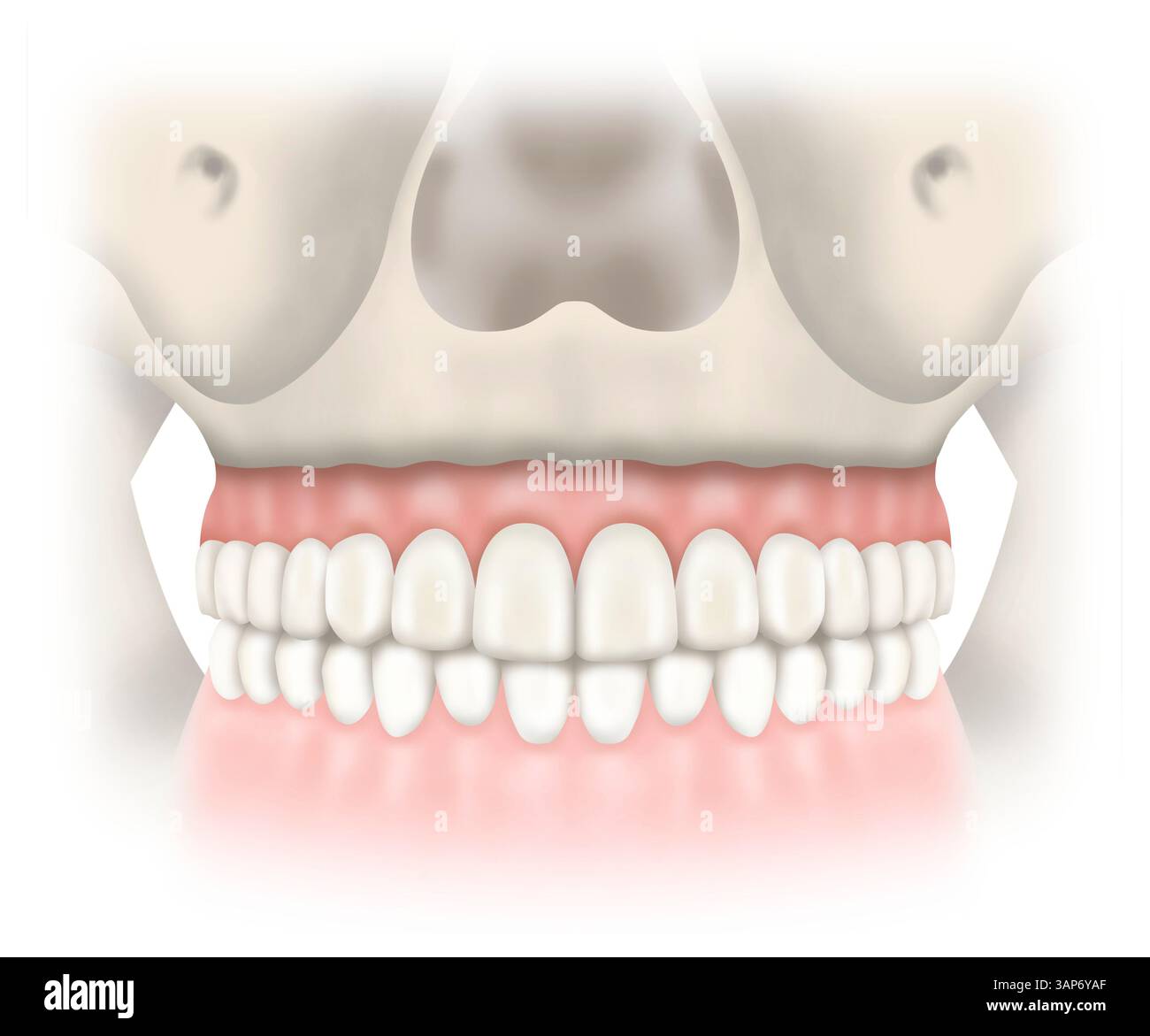 Resorbed maxilla (upper jaw) with composite defect, illustration. A ...