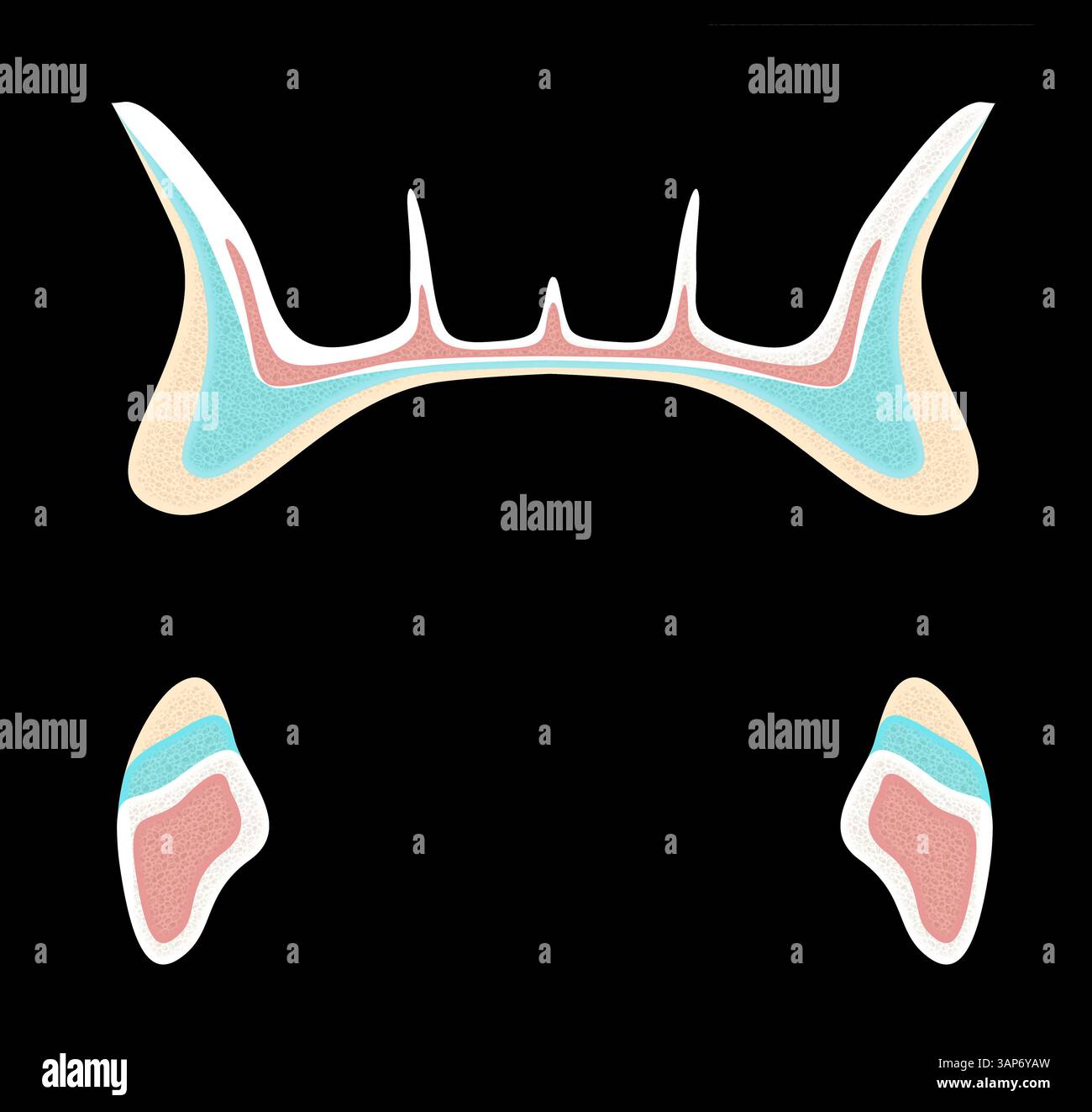 Illustration of a paranasal section through a severely resorbed maxilla ...