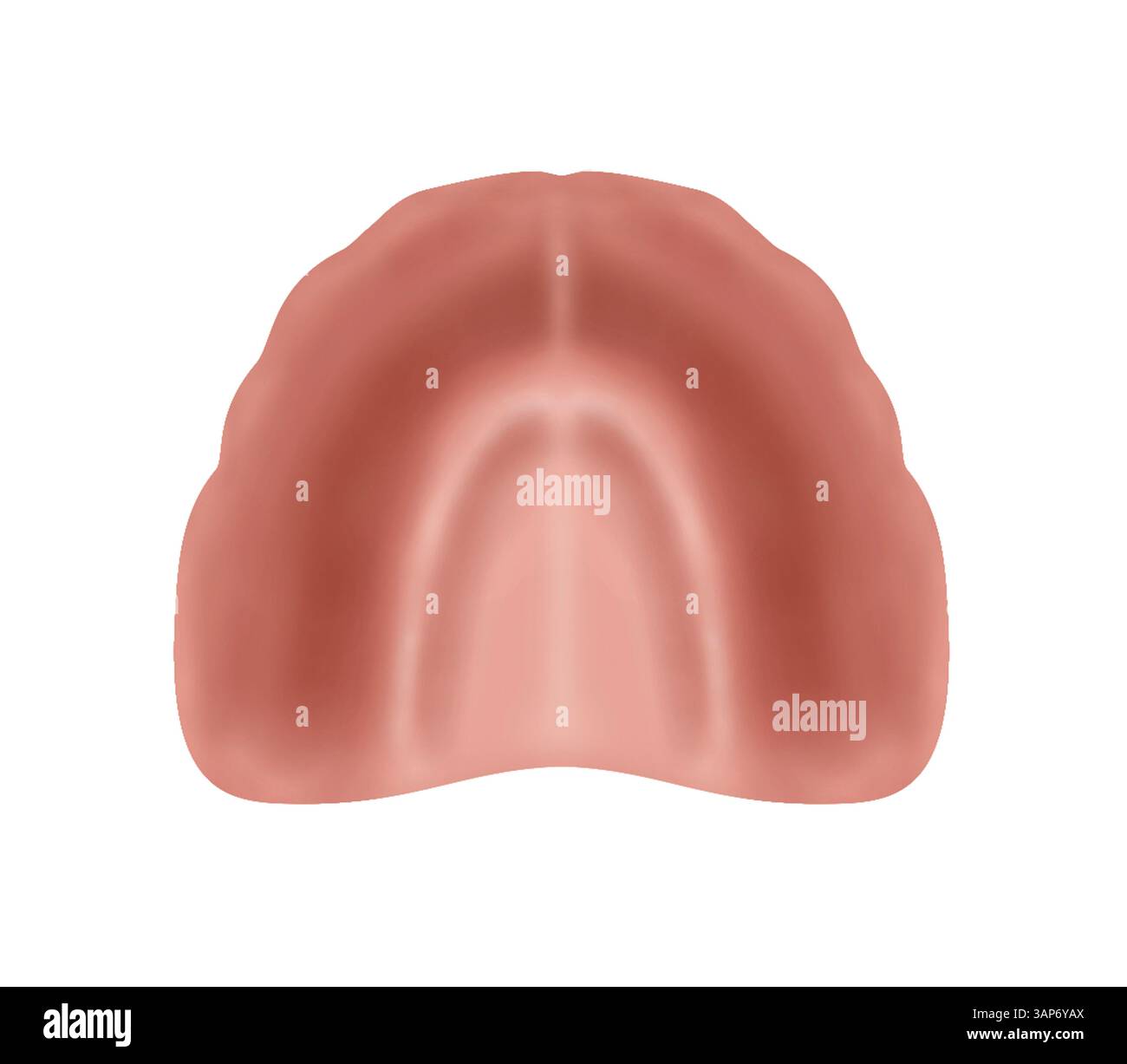 Illustration of a severely resorbed edentulous maxillary (upper jaw ...