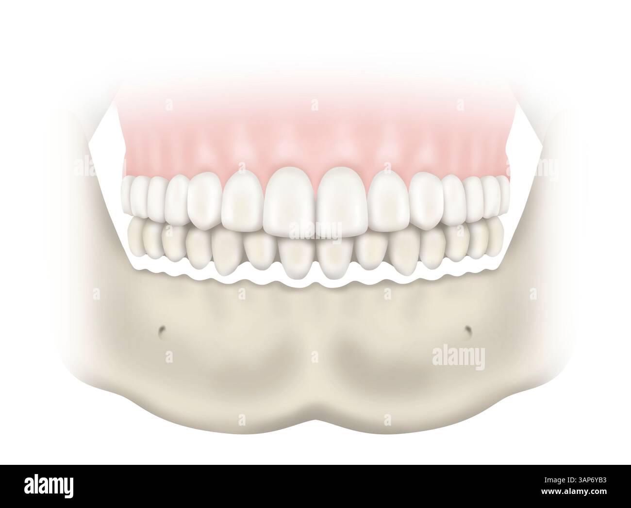 Anterior resorbed mandible (lower jaw) with composite defect ...
