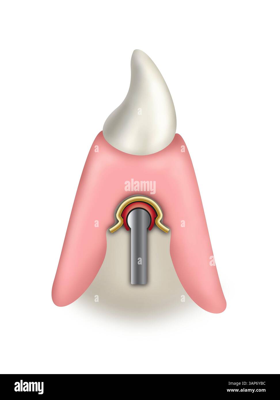 Illustration of a mandibular (lower jaw) tooth with a bar-supported ...