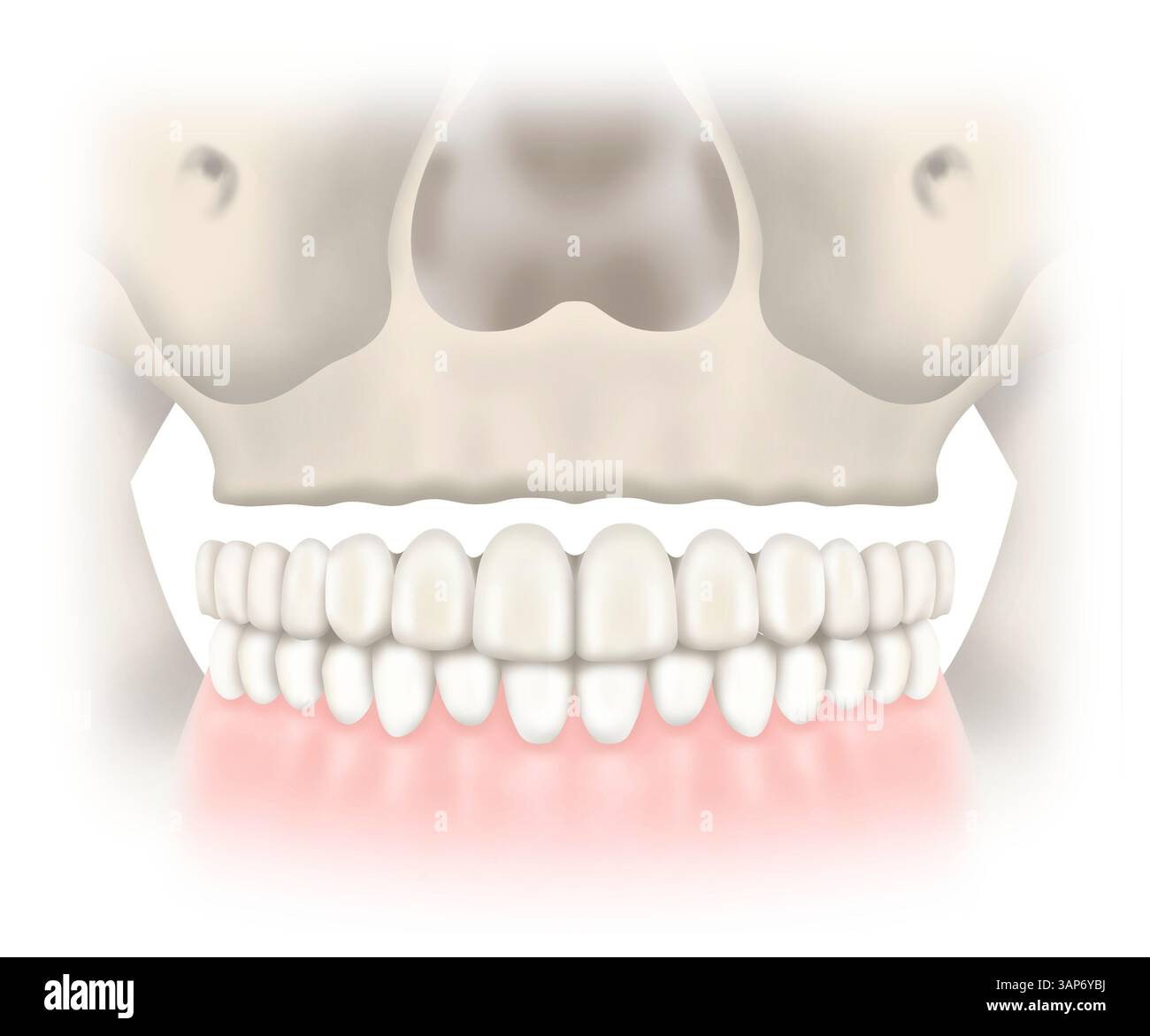 Mildly resorbed maxilla (upper jaw) with composite defect, illustration ...