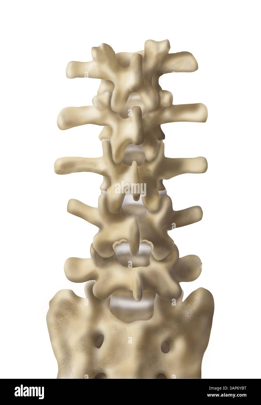 Illustration of a bilateral laminotomy for bilateral decompression ...