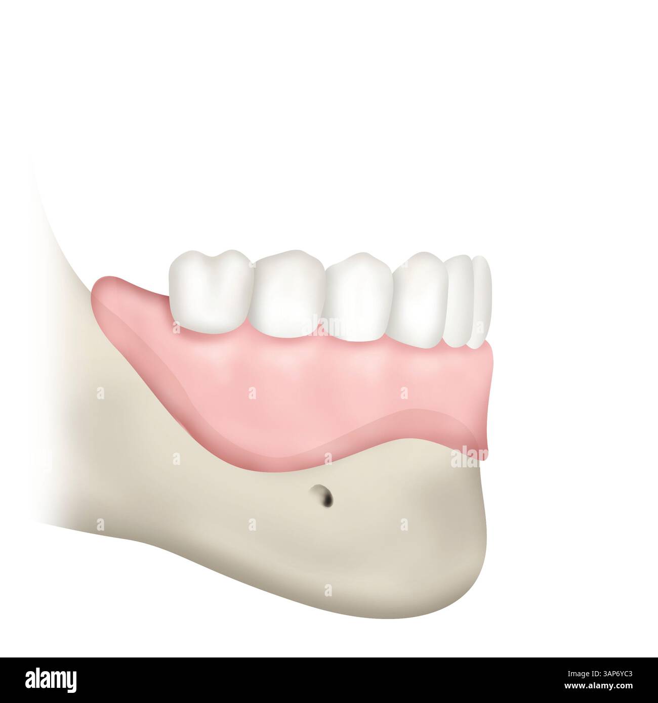 Illustration of a severely resorbed mandible (lower jaw) with an angled ...