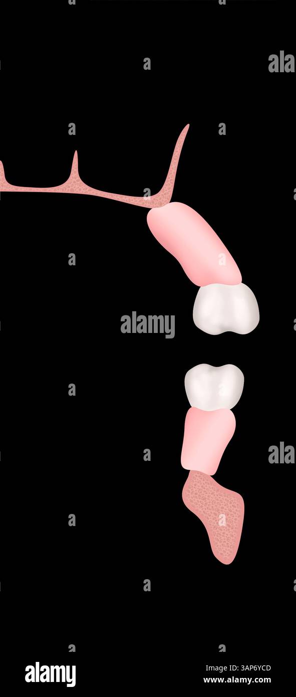 Illustration showing jaw resorption in relation to the presence of a ...